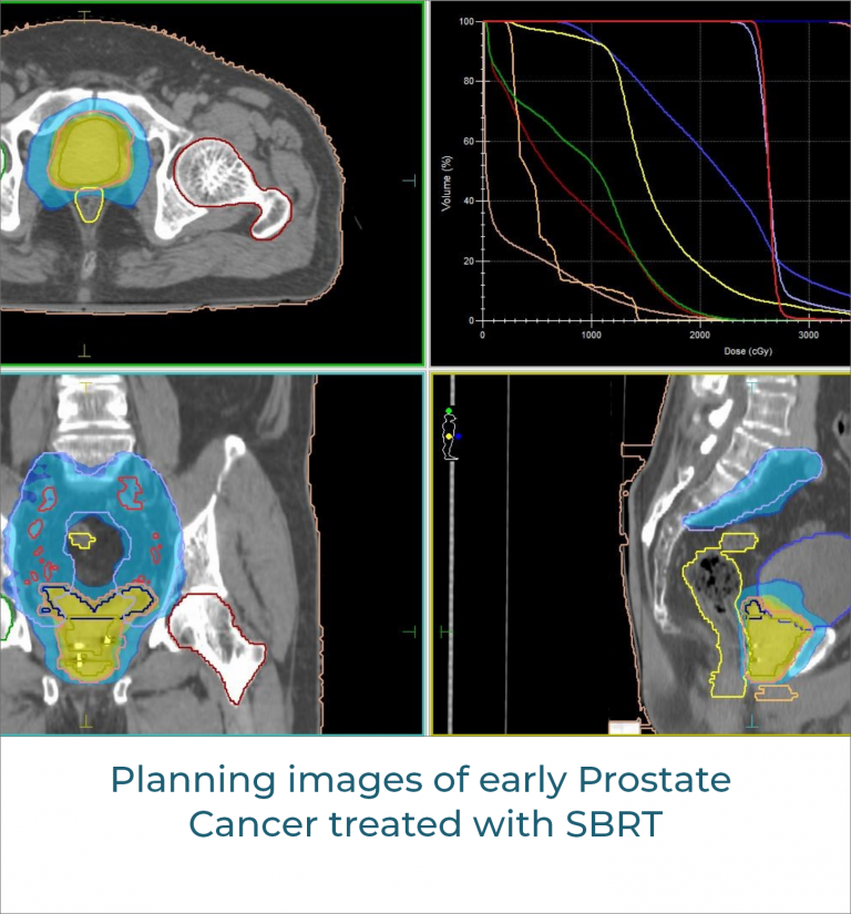 Stereotactic Body Radiation Therapy (SBRT) – Dr. Saurabha Kumar